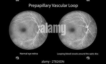 Prepapillary vascular loop on the retina, illustration Stock Photo - Alamy