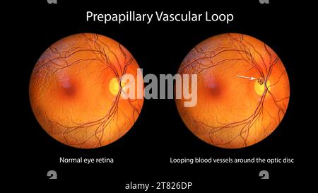 Illustration of a prepapillary vascular loop on the retina, as observed ...