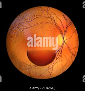 Subhyaloid haemorrhage, illustration Stock Photo - Alamy