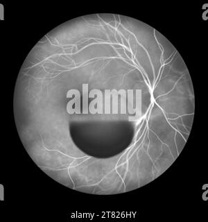 Subhyaloid haemorrhage, illustration Stock Photo - Alamy