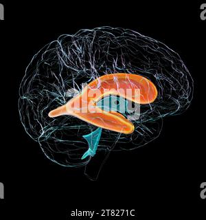 Computer illustration depicting enlarged lateral ventricles ...