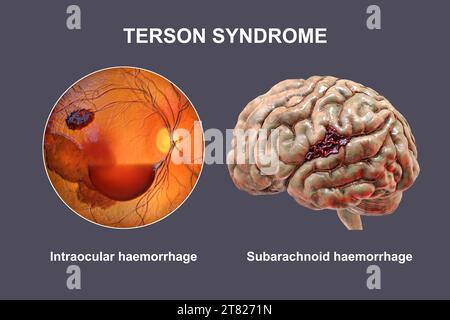 Terson syndrome, illustration Stock Photo - Alamy