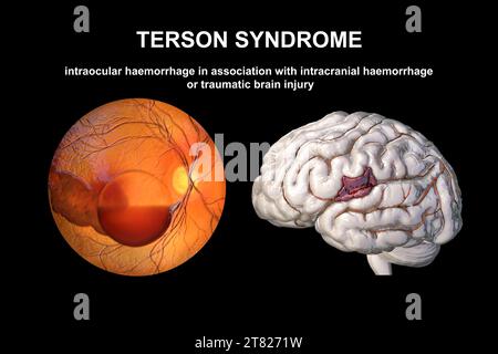 Terson syndrome, illustration Stock Photo - Alamy