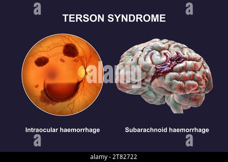 Terson syndrome, illustration Stock Photo - Alamy