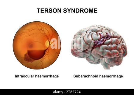 Terson syndrome, illustration Stock Photo - Alamy