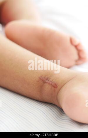 Stitched wound mark on a child foot Stock Photo - Alamy