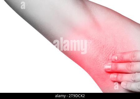 Closeup of female armpit with redness. Skin irritation or swollen lymph ...