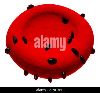 Sickle cell anaemia. Artwork of red blood cells in sickle cell anaemia ...