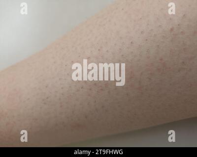 rash eczema dermatitis on leg. inflammation of skin Stock Photo - Alamy