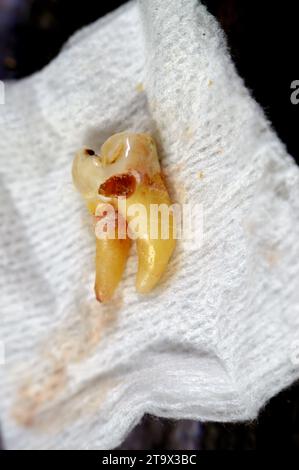 Extracted wisdom 8th lower right tooth with a teeth decay, after ...