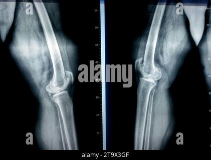 Plain X ray of both knee joints shows apparent joint osteoarthritis ...