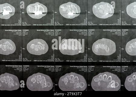 Cairo, Egypt, October 18 2023: CT scan left wrist joint showing a ...