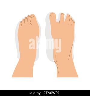 Top view comparison of healthy and deformed feet after wearing regular ...