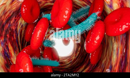 Sepsis is a potentially life-threatening condition caused by the body's ...