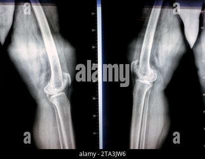 Plain X ray of both knee joints shows apparent joint osteoarthritis ...