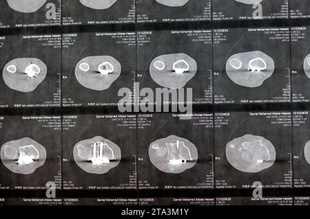 Cairo, Egypt, October 18 2023: CT scan left wrist joint showing a ...
