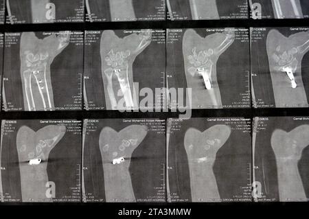 Cairo, Egypt, October 18 2023: CT scan left wrist joint showing a ...