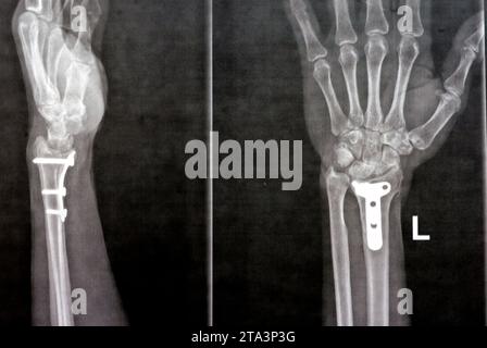 Plain x ray showing a recent fissure fracture at the lower part of a ...
