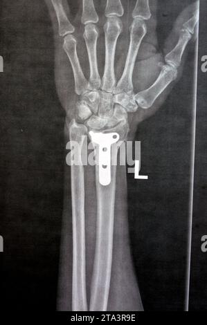Plain x ray showing a recent fissure fracture at the lower part of a ...