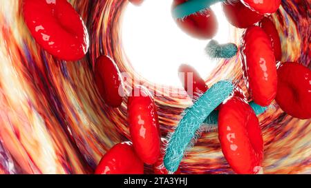 Sepsis is a potentially life-threatening condition caused by the body's ...