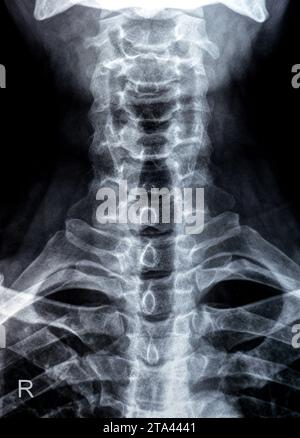 Plain X ray of cervical spine revealed straightened cervical curve ...