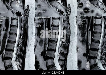 Cairo, Egypt, November 14 2023: MRI of lumbosacral spine revealed L3-L4 ...