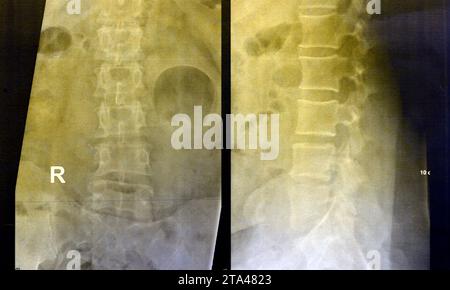 Plain X ray lumbosacral spine revealed straightened, mild scoliotic ...
