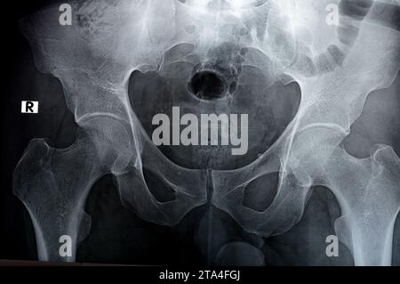 Hip joints digital radiographic examination reveals normal appearance ...