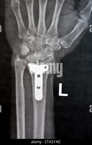 Plain x ray showing a recent fissure fracture at the lower part of a ...