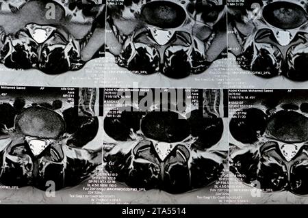 Cairo, Egypt, November 14 2023: MRI of lumbosacral spine revealed L3-L4 ...