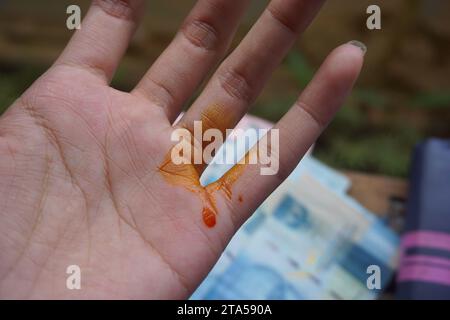 Stock photo of sores forming scabs on hands and arms. Injury occurred ...