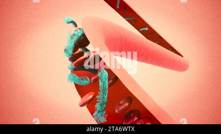 Sepsis is a potentially life-threatening condition caused by the body's ...