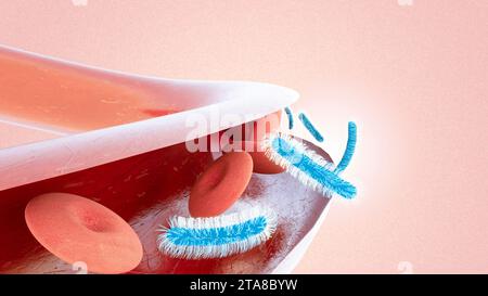 Sepsis is a potentially life-threatening condition caused by the body's ...