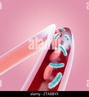 Sepsis is a potentially life-threatening condition caused by the body's ...