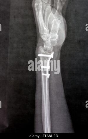 Plain x ray showing a recent fissure fracture at the lower part of a ...