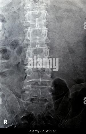 Plain X ray lumbosacral spine revealed straightened, mild scoliotic ...