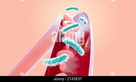 Sepsis is a potentially life-threatening condition caused by the body's ...