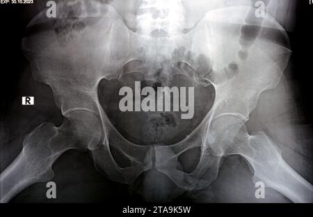 Hip joints digital radiographic examination reveals normal appearance ...