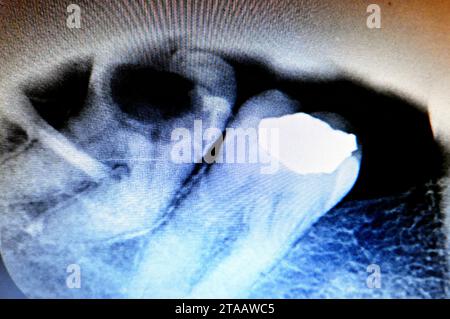 X ray on wisdom 8th lower right tooth with a teeth decay, after exposed ...