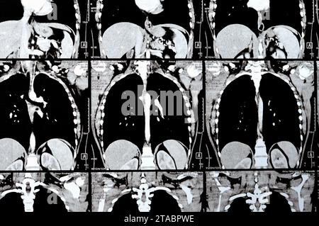 Tuberculosis of the lung. Computed tomography (CT) scan of an axial ...