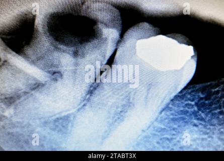 X ray on wisdom 8th lower right tooth with a teeth decay, after exposed ...