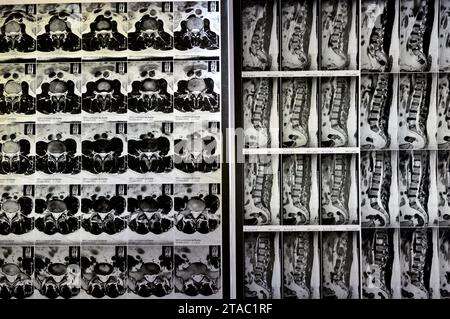 MRI lumbosacral spine without contrast revealed back muscle spasm, Mild ...