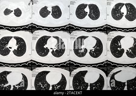 Tuberculosis of the lung. Computed tomography (CT) scan of an axial ...