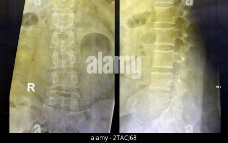 Plain X ray lumbosacral spine revealed straightened, mild scoliotic ...
