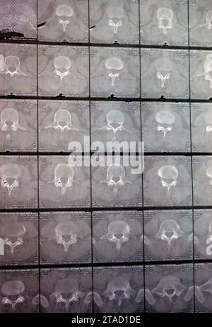 Lumbar spine, CT scan Stock Photo - Alamy