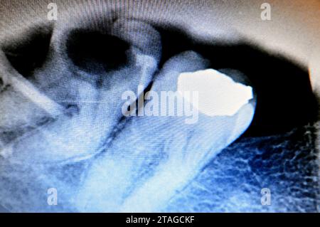 X ray on wisdom 8th lower right tooth with a teeth decay, after exposed ...