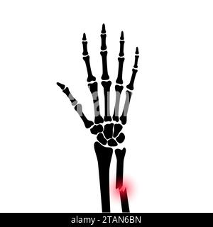 Fractured arm, illustration Stock Photo - Alamy