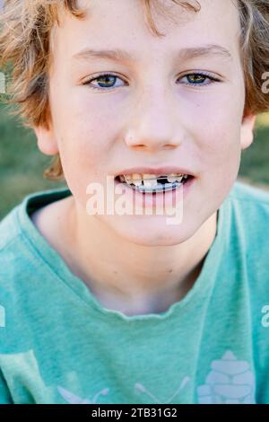 Child with orthodontic appliance to correct malocclusion, forward bite ...