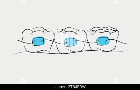 Teeth braces illustration drawing in linear style on white color ...