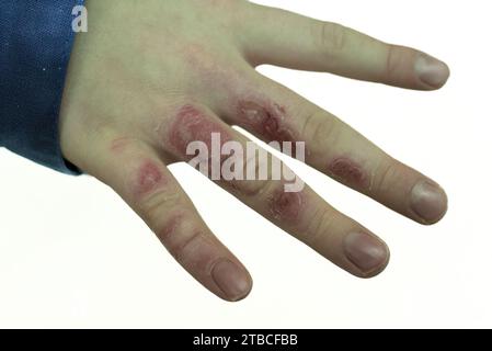 Wound of a child's hand with a thermal burn of the skin after boiling ...